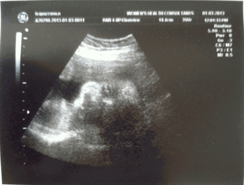 Trap Family: 30 Week Growth Scan - Izzie B