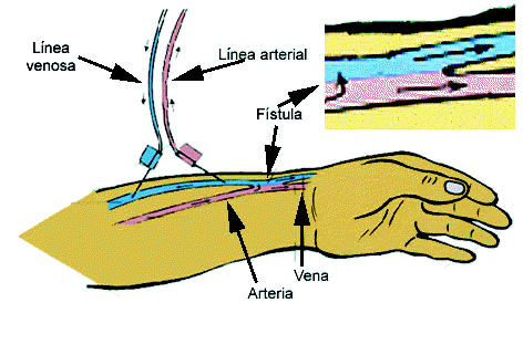Enfermería en hemodiálisis