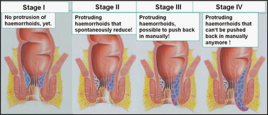 HEMOROID Healthy It Easy hemoroid-healthy-it-easy