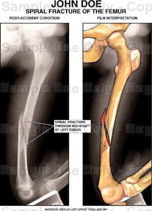 Fracture/Dislocation/Sublaxation ~ Anatomy for MSP