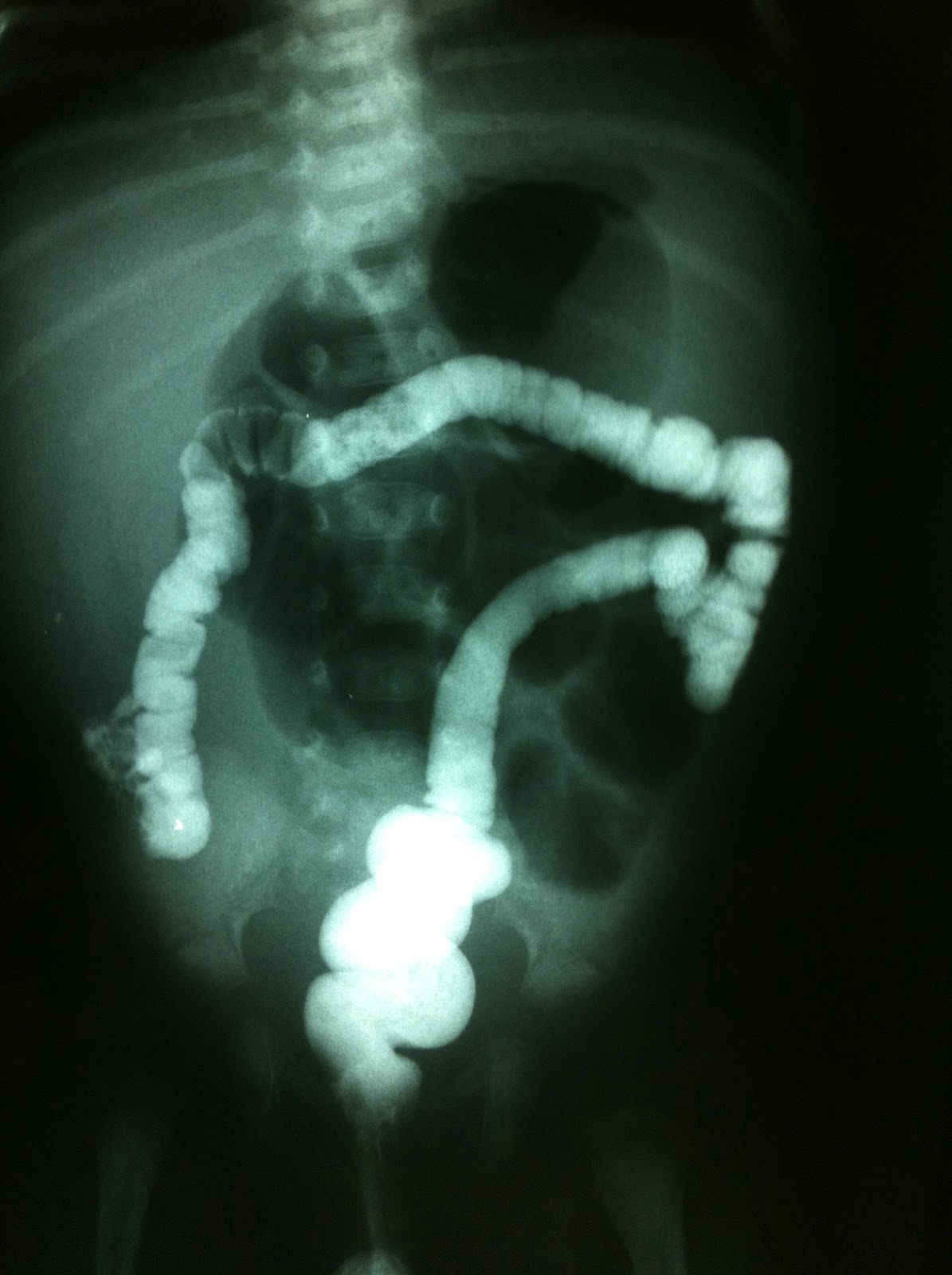 Radiologia Pediátrica: MICROCÓLON