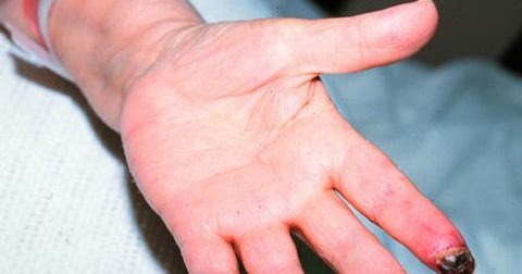 About Health: Ischemia