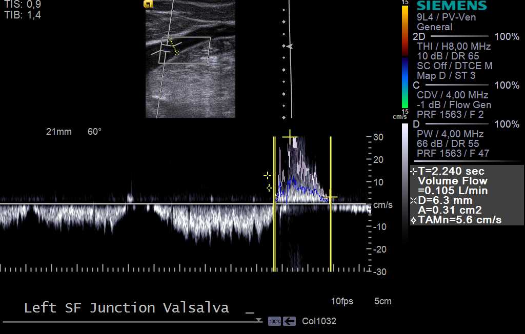 Nevit's blog: Calculating the total volume of reflux in venous ...