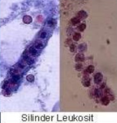 kimia klinik: Pemeriksaan sedimen urine