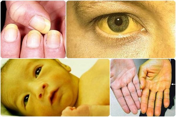 Penyakit Kuning - Pengertian, Penyebab, Gejala, Pengobatan, Pencegahan ...