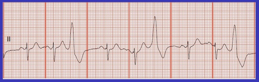 EKG Rhythm Strip Quiz 198