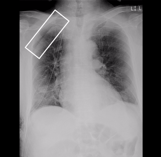 Producción y Tratamiento de Imágenes Diagnósticas: LINEAS DE MACH EN ...