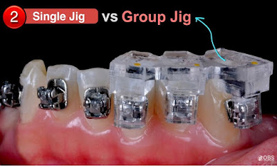 ORTHODONTICS: Rebonding Tips for the Custom Bracket System-Insignia ...