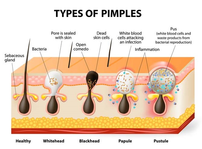 Pimples Causes, Symptoms and Treatments | Get Rid Of Acne