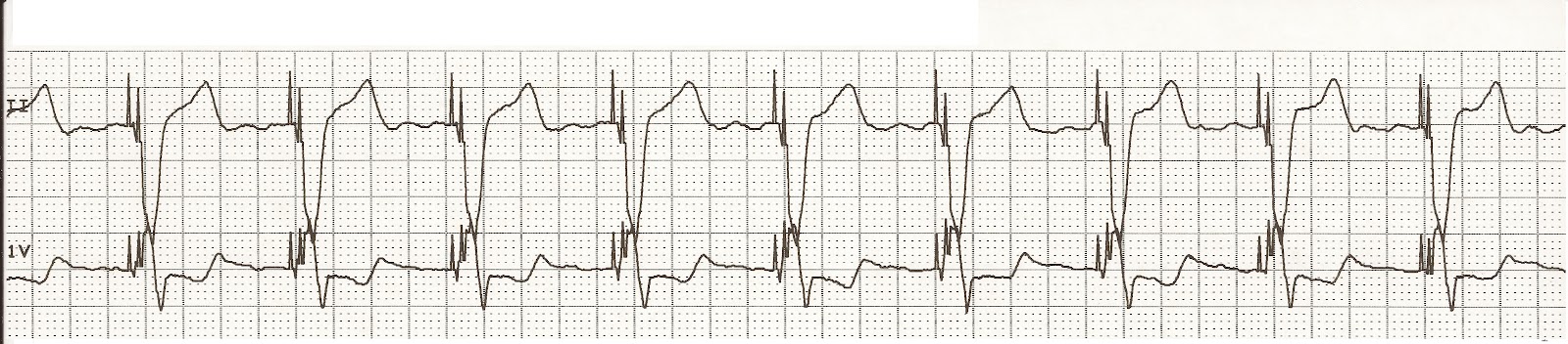 EKG Rhythm Strip Quiz 56: Paced Rhythms