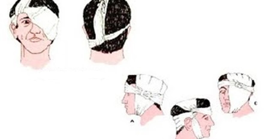 PROTOCOLO DE PRIMEROS AUXILIOS "VENDAJES": VENDAJE PARA EL OJO