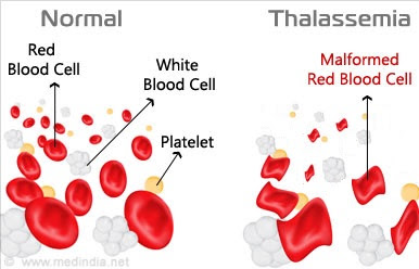 HEMOGLOBINOPATÍAS : TALASEMIAS: INTRODUCCIÓN (Por Celia J. Revilla)