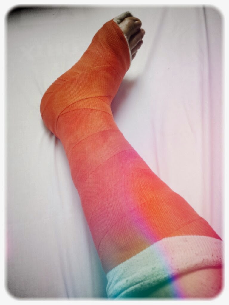 Living with Posterior Tibial Tendon Dysfunction (PTTD) - To Surgery ...