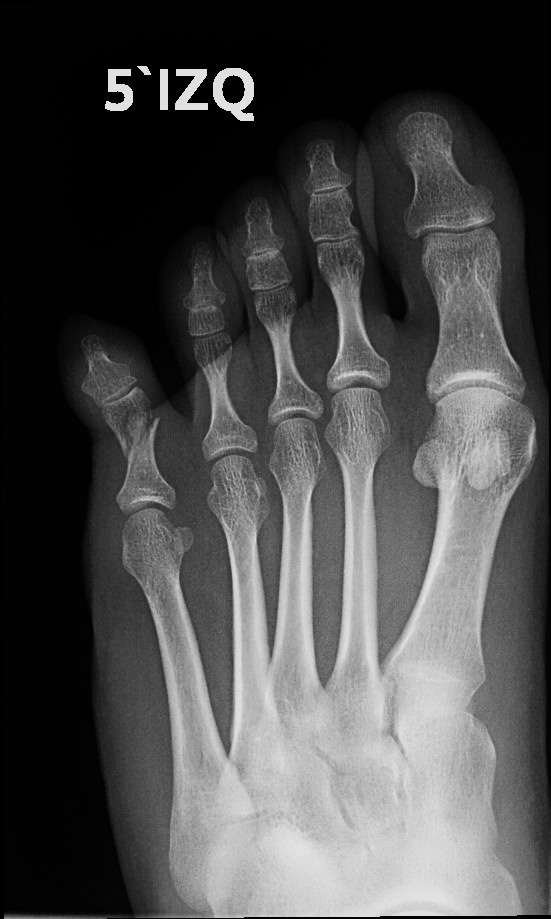 Traumatólogo de Guardia - Pedro Larrauri - Vigo.: Fractura del quinto ...