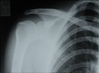 Radiología Silva2: Hombro AP