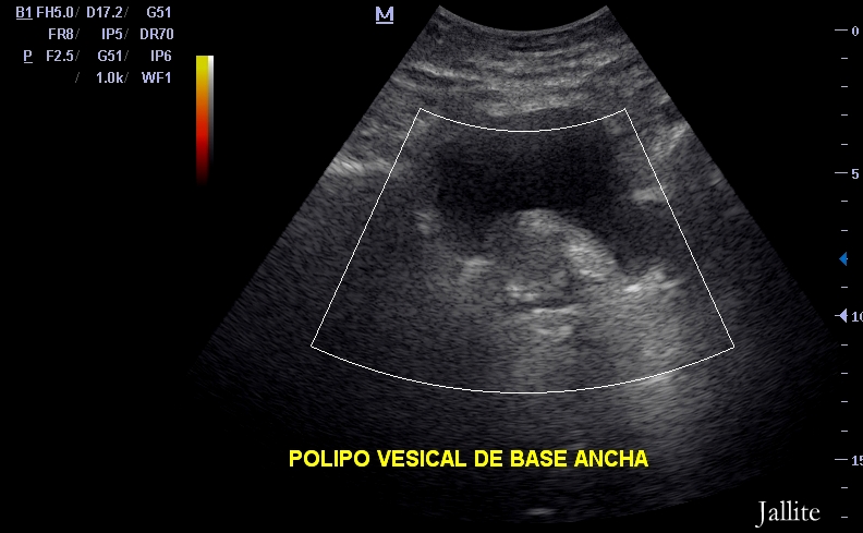 Pólipo Vs Endometrioma Vesical