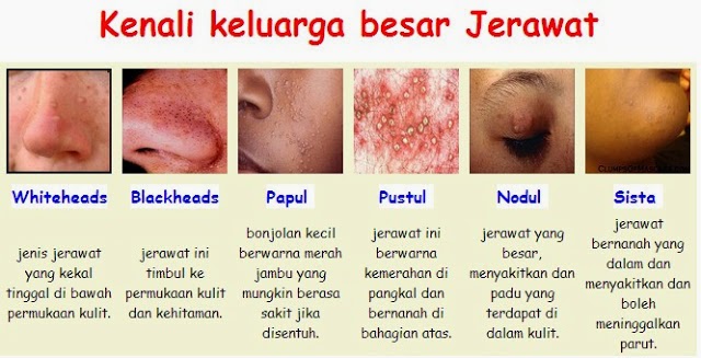 Tip Sihat Dan Cantik: JERAWAT ! ! MARI KITA FAHAMI TENTANG JERAWAT