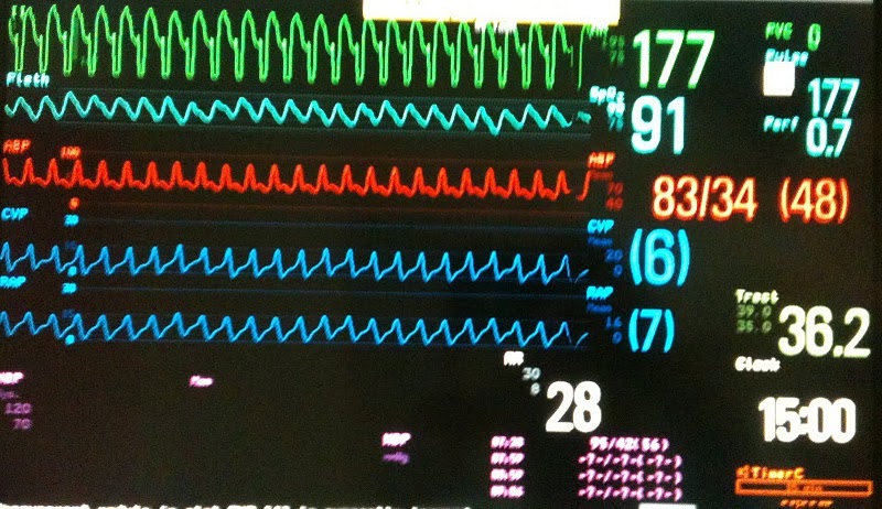Pedi cardiology: EP: Postoperative JET - Diagnosis