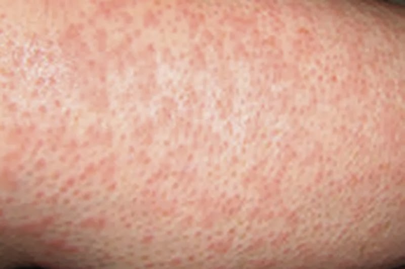 Heat Rash On Arms And Legs