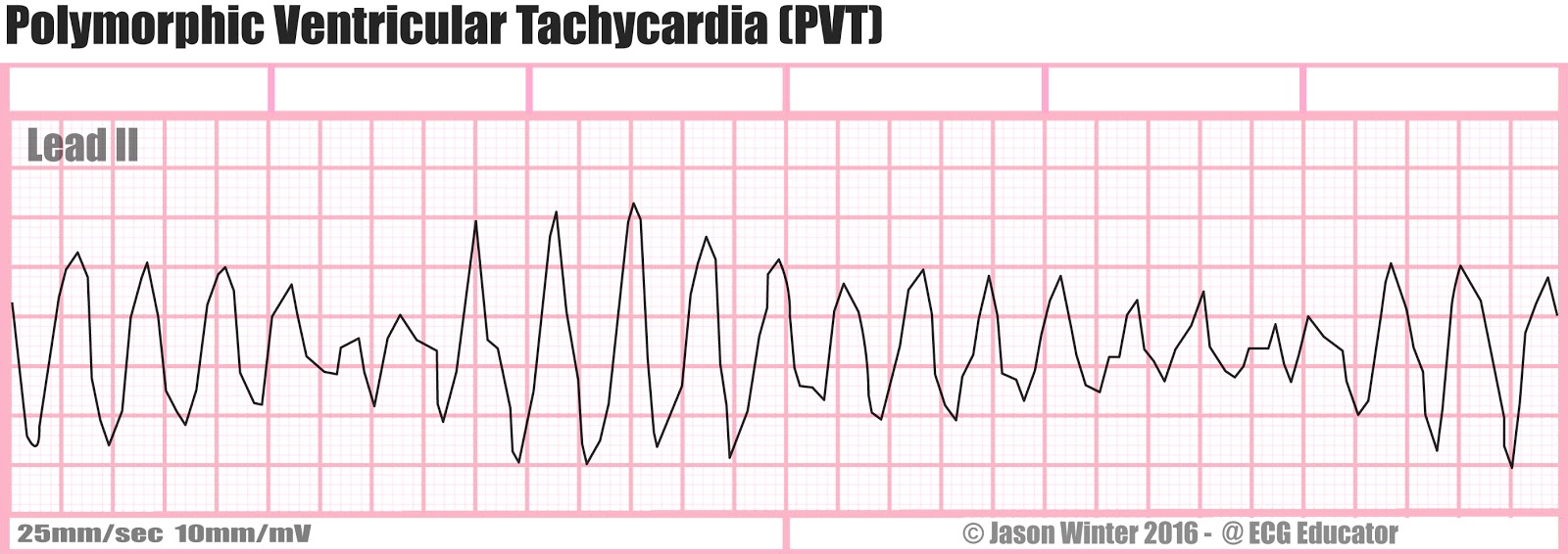 ECG Educator Blog : Ventricular Rhythms