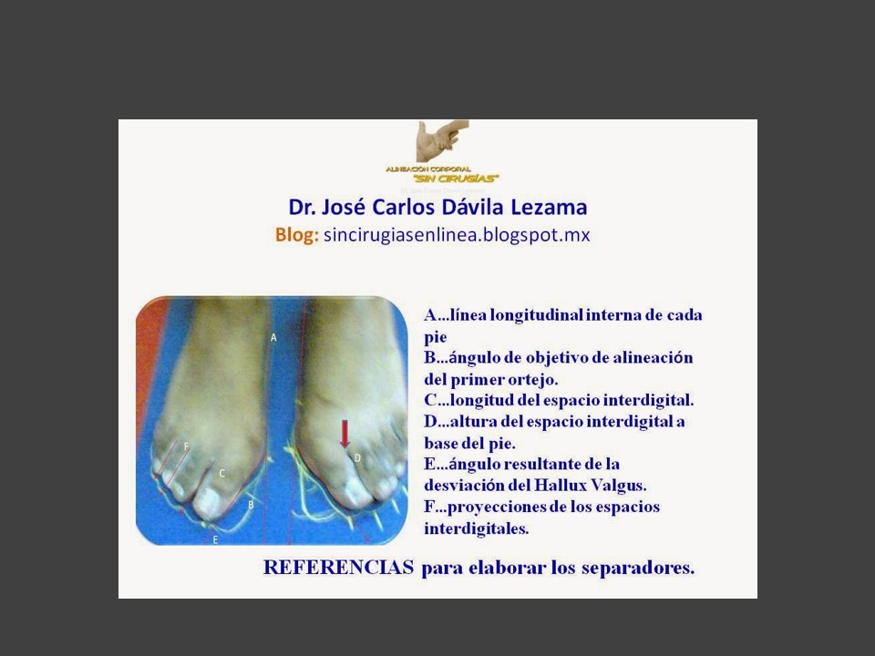 SIN CIRUGÍAS en LÍNEA