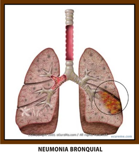 TU SALUD Y LA NUTRICIÓN.: LA NEUMONIA