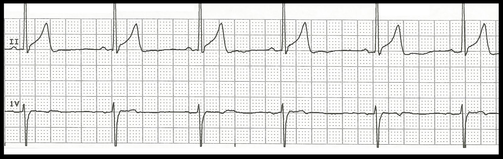 EKG Rhythm Strip Quiz 122