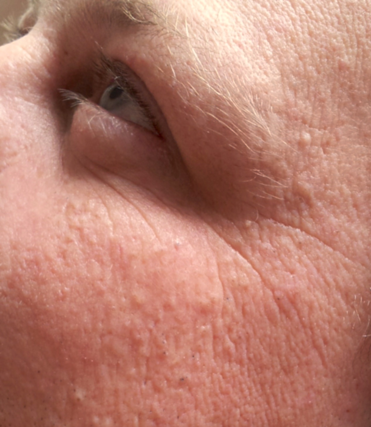 So life begins at 40 does it?: Environ Skin Peel - For Men!