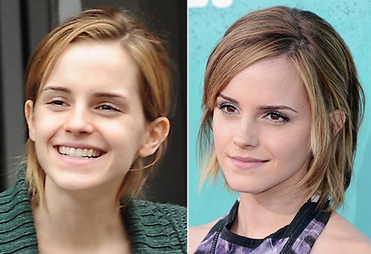 Emma Watson Braces