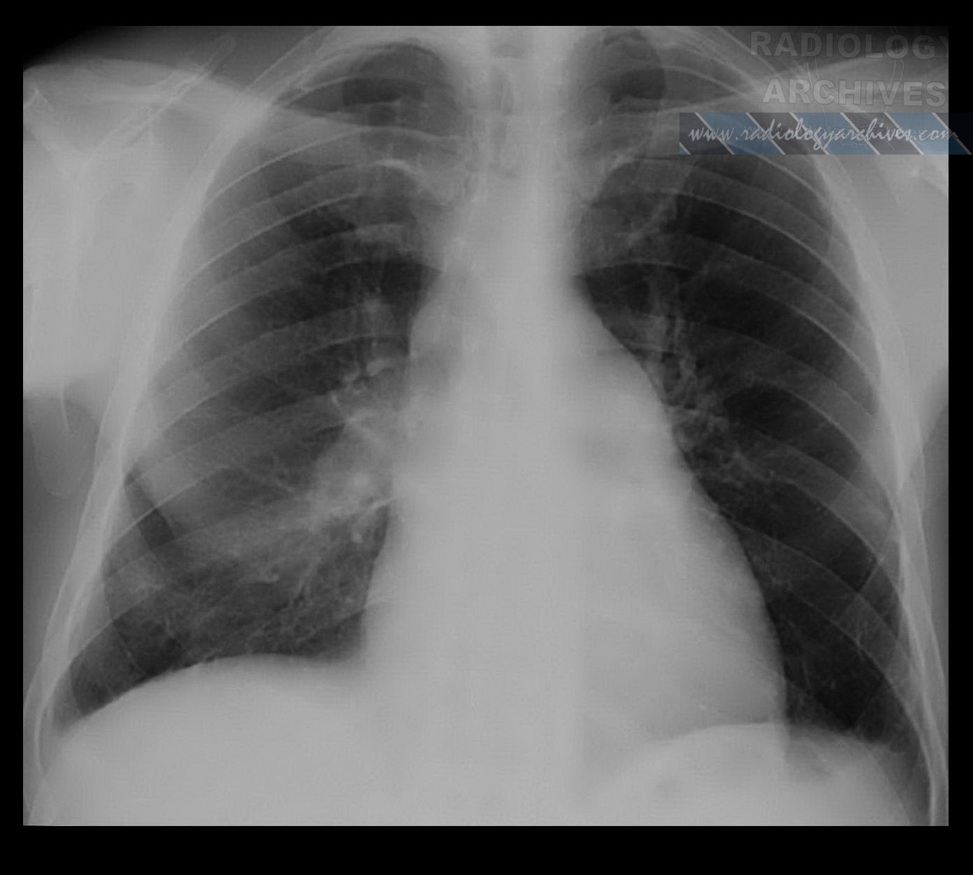 Radiology Archives: Πνευμονική Εμβολή (Σημείο Westermark)