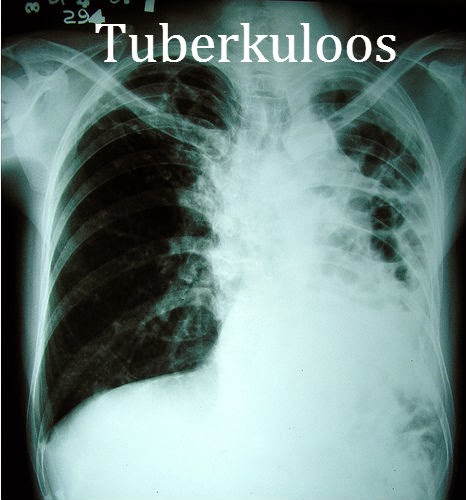 tuberculosis.jpg