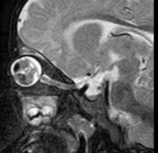 Retinoblastoma-MRI - Sumer's Radiology Blog