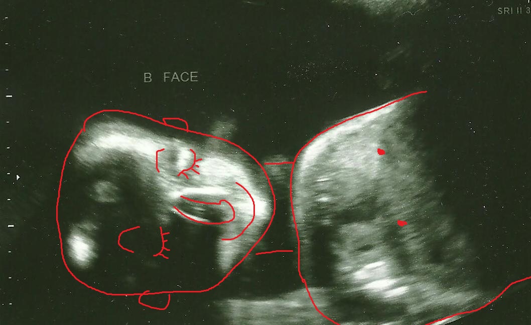 2 New Rubys: 31 Weeks: Growth Scan + MFM appt