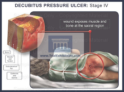 "THIS AIN'T NO GAME SHOW!": Stage III - Stage IV Pressure Ulcer