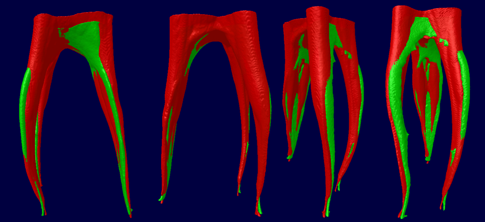 The Root Canal Anatomy Project: Root Canal Preparation: Gates-Glidden ...
