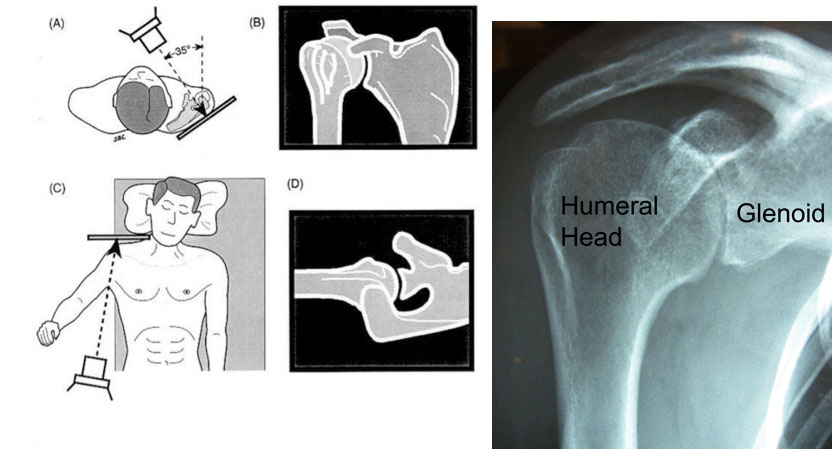 UW Shoulder and Elbow Academy: Reverse Total Shoulder for Combined ...