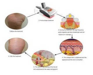 The beauty machine World: Kuma shape machine for tighten skin,wrinkle ...