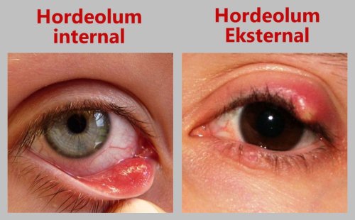 4 Natural ways to Cure Hordeolum ~ kesterluc