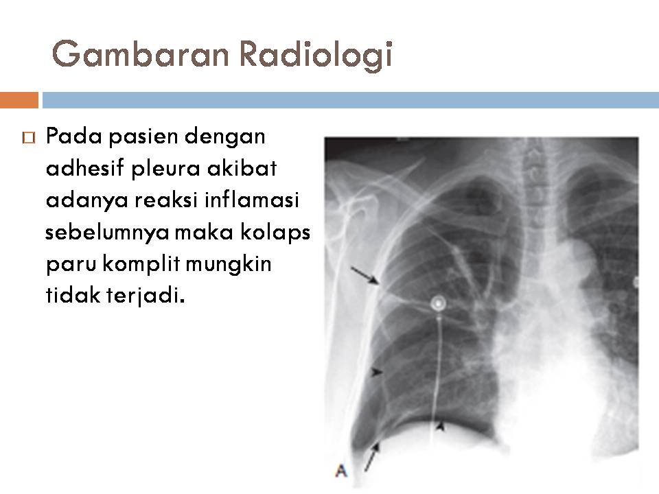 Gambaran Radiologis Pneumotoraks