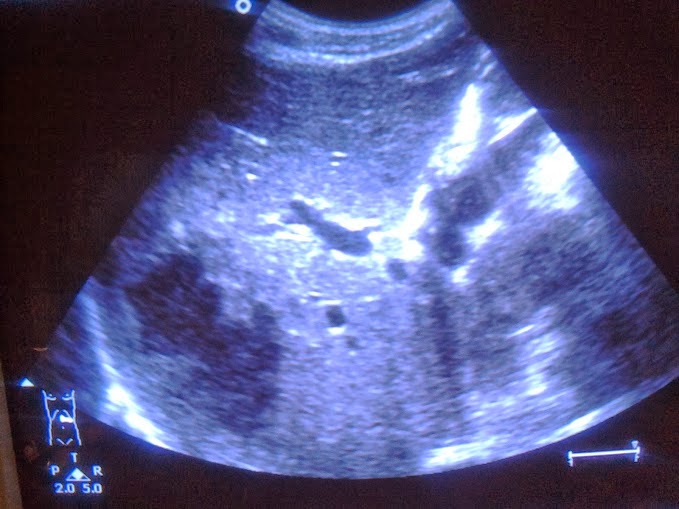 AMOEBIC LIVER ABSCESS