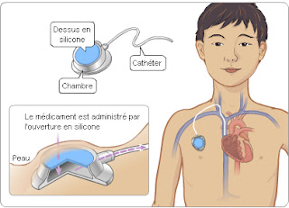 SASI 101-InfAux (Santé, assistance et soins infirmiers): Cathéter à ...