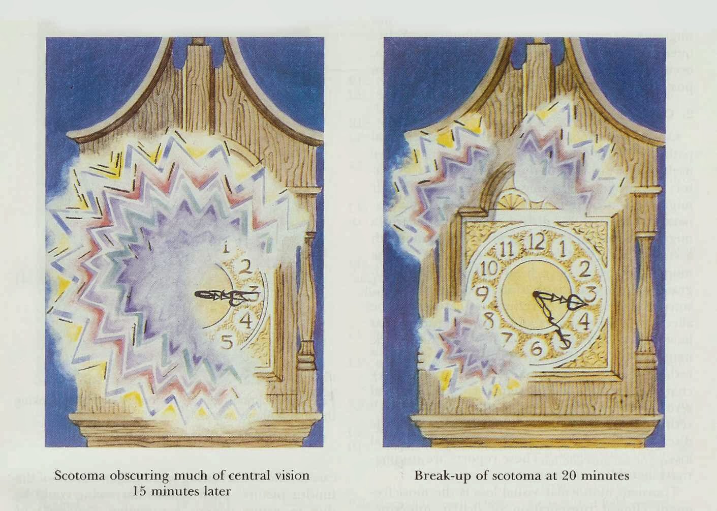 Pharmaceutical Advertisement Collection: Migraine with aura (Visual Aura)