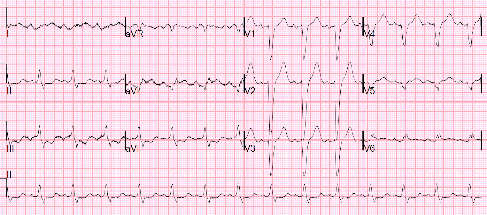 Dr. Smith's ECG Blog: Left Bundle Branch Block, Severe Chest pain ...