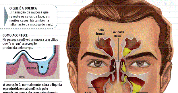 O que é a sinusite?