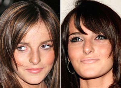 Ali Lohan Surgery