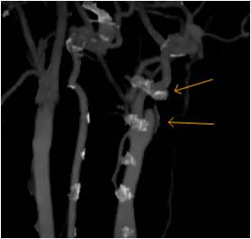 Post Traumatic ICA dissection-CT angiography - Sumer's Radiology Blog