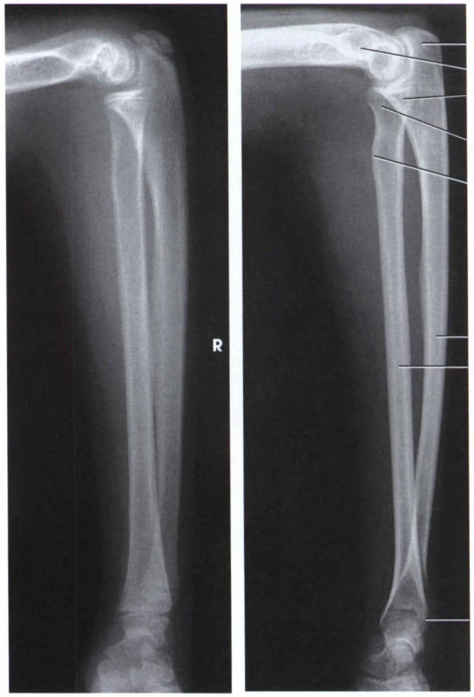 Gudang Medis: teknik radiografi antebrachii