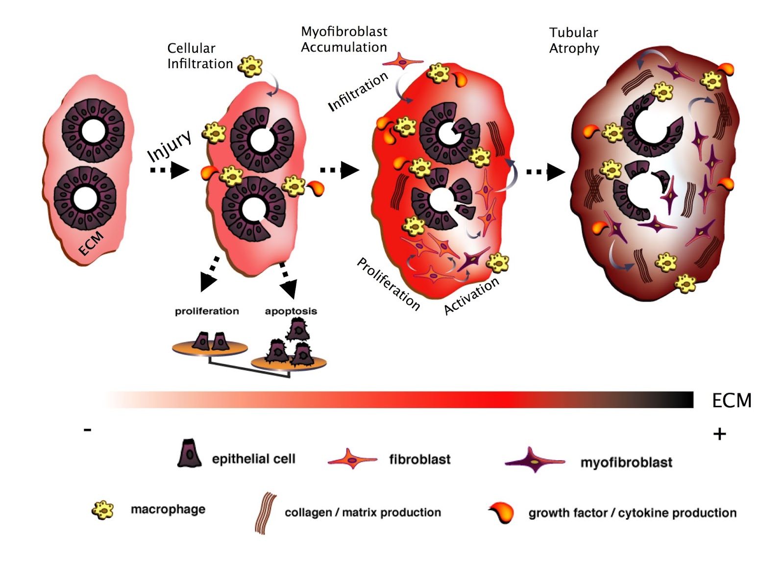 treatment for kidney disease: Can Renal Fibrosis be Reversed?