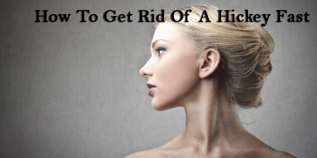 Common Ways to Remove Love Bite | How to get rid of a hickey ~ Article ...