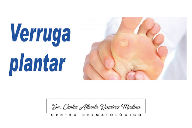 Centro Dermatológico Dr. Ramírez Medina: VERRUGAS PLANTARES